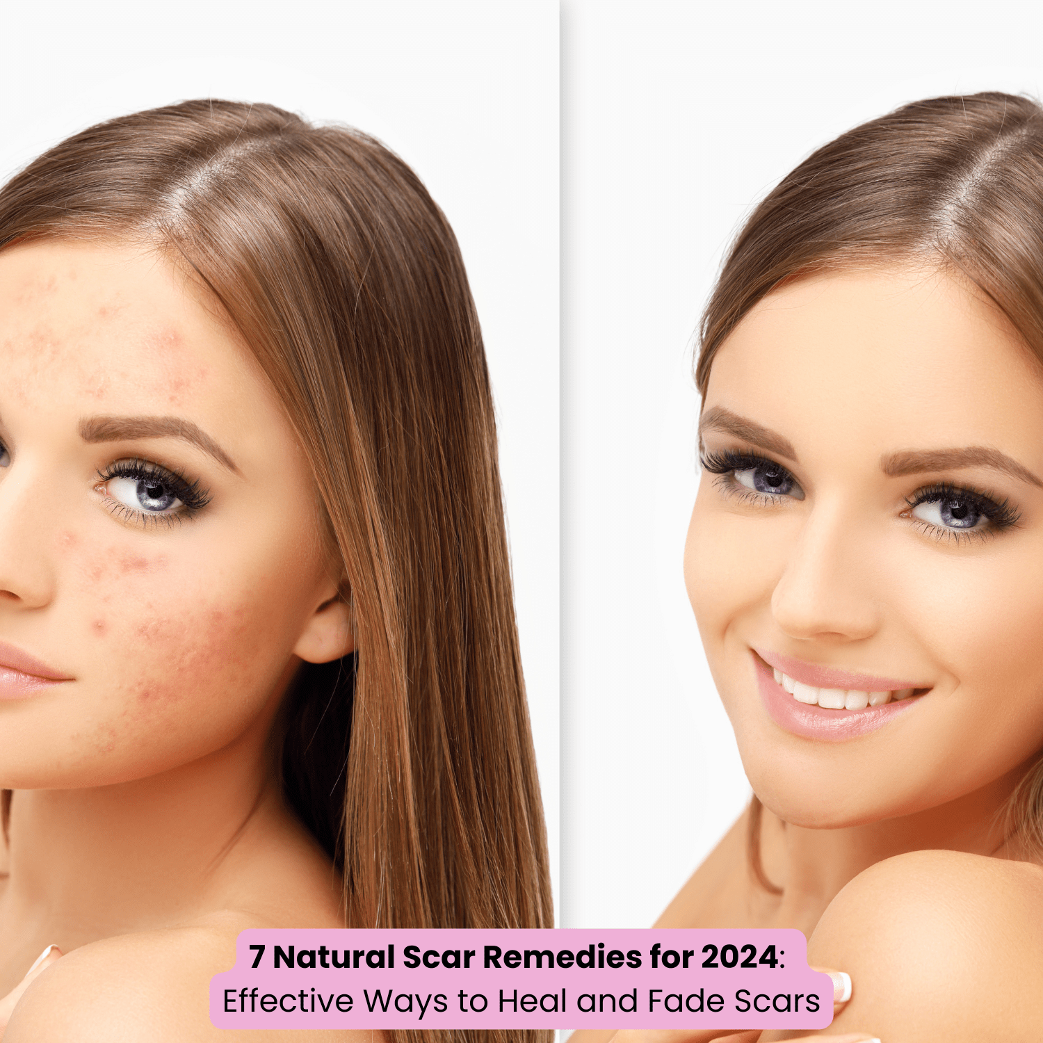 7 Natural Scar Remedies for 2024: Effective Ways to Heal and Fade Scars ...